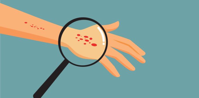 Shingles, psoriasis on Vic pharmacy prescribing list - Dermatology Republic